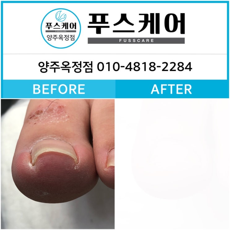 양주파고드는발톱 고등학생 파고드는 발톱 때문에 욱신욱신 아파요 네이버 블로그