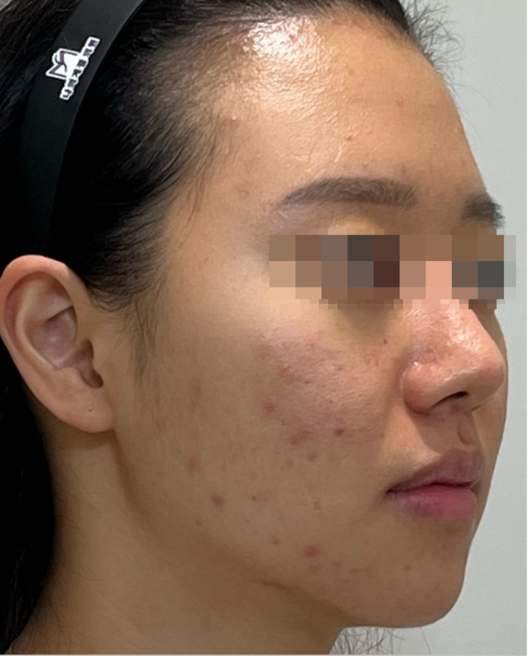 대구 여드름 피부과 나의계절의원 치료 과정 후기 여드름약 만이 능사가 아닙니다 네이버 블로그