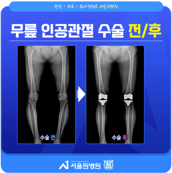 Tkr 4 무릎인공관절치환술 Qanda 2탄 인공관절감염 재치환술 인공관절 수명 수술 후 주의사항 네이버 블로그