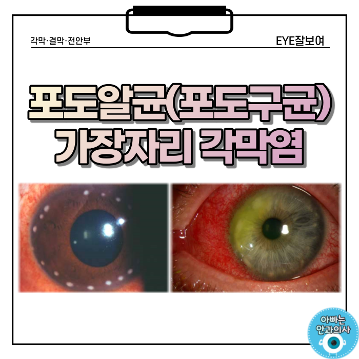 포도알균 가장자리 각막염(Staphylococcal Marginal Keratitis) - 원인, 증상, 진단, 치료 : 네이버 블로그