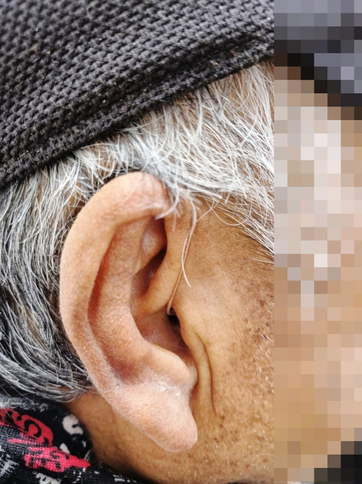 밀양보청기밀양독일보청기밀양시그니아독일보청기공식인정 전문센터~ 청각장애등급을 진행하여서 보조금도 받고 보청기를 구입하신