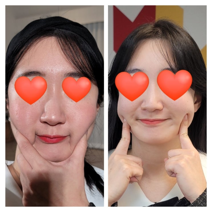 편평사마귀 어븀야그 레이저 제거 후기 얼굴 목 전부 제거 네이버 블로그