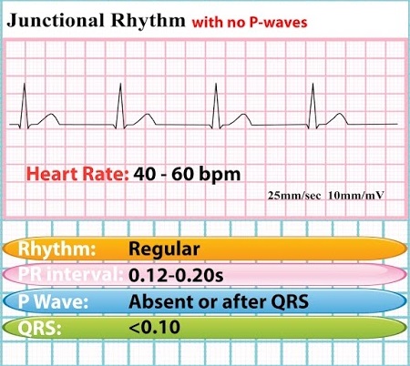 심전도로 보는 부정맥[20] - 방실접합부 리듬[Junctional Rythem] : 네이버 블로그