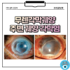 각막 주변이 염증으로 녹는 무렌 각막궤양 뮤렌 각막궤양feat 주변부 궤양 각막염 네이버 블로그