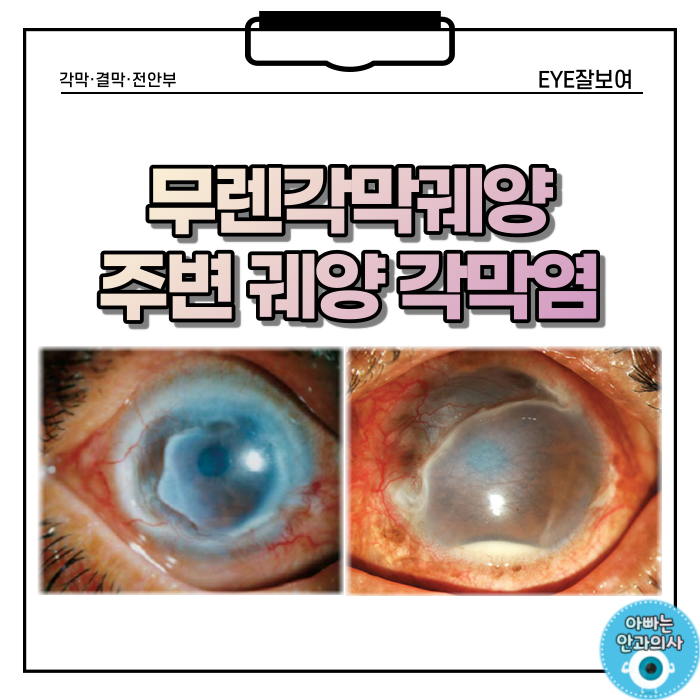 각막 주변이 염증으로 녹는 무렌 각막궤양 뮤렌 각막궤양feat 주변부 궤양 각막염 네이버 블로그