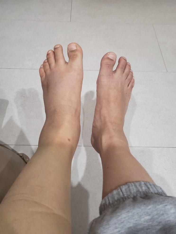 발목인대파열 2주차 후기목발 졸업 발목 초음파 에어캐스트 부목 한방 치료비 네이버 블로그