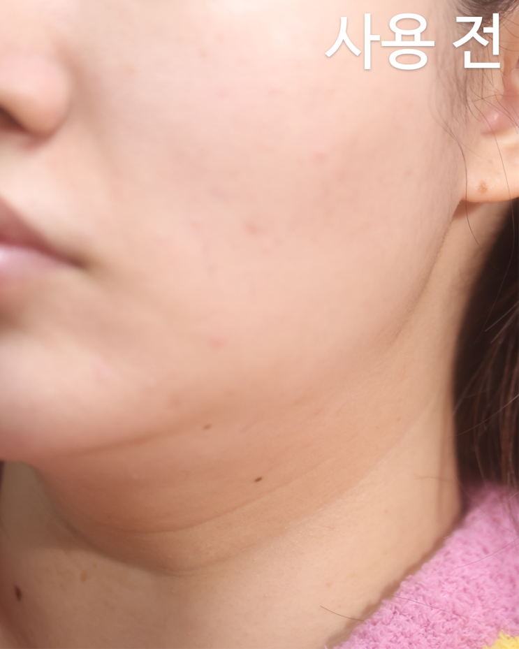 집에서하는 울쎄라 초음파리프팅 리프텐공구 리프팅기기 홈케어관리기기 추천 네이버 블로그