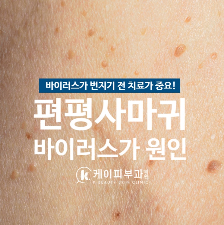 부산편평사마귀 제거 얼굴 목 몸 바이러스가 남지 않아야 네이버 블로그