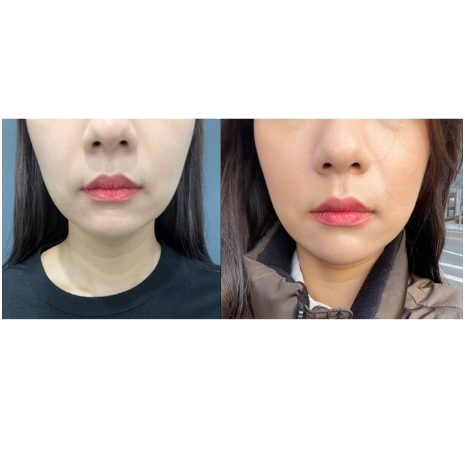잠실인모드 포마 얼굴전체 1주차 후기 통증 멍 시간 주기 세안 가격 네이버 블로그
