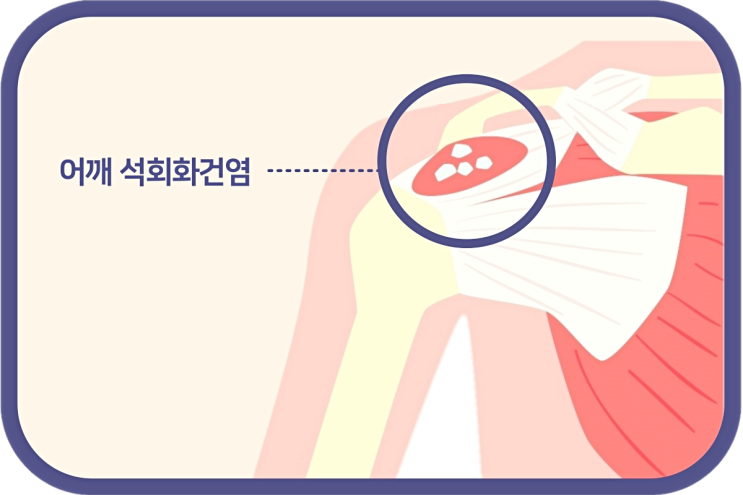 어깨 석회화건염 갑작스러운 극심한 통증 빠른 호전 돕는 치료로 네이버 블로그