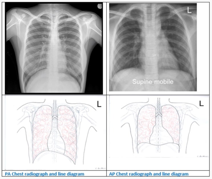 Chest PA & AP 흉부 X-ray 비용 및 판독 공부하기 : 네이버 블로그