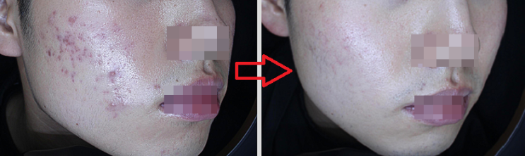 화곡 리뉴미피부과 여드름 흉터 여드름 붉은 자국 레이저 치료 경과 송정 계양 청라 영종 계산동 마곡 시흥 광명
