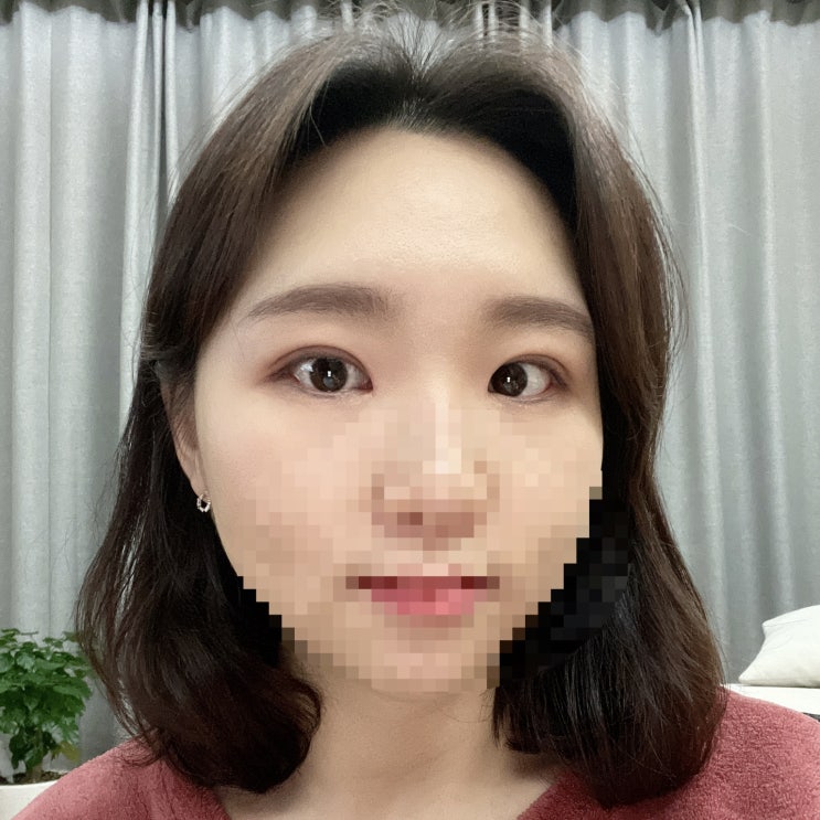 절개쌍수 눈매교정 재수술 후기4 쌍수 한달 후기 네이버 블로그