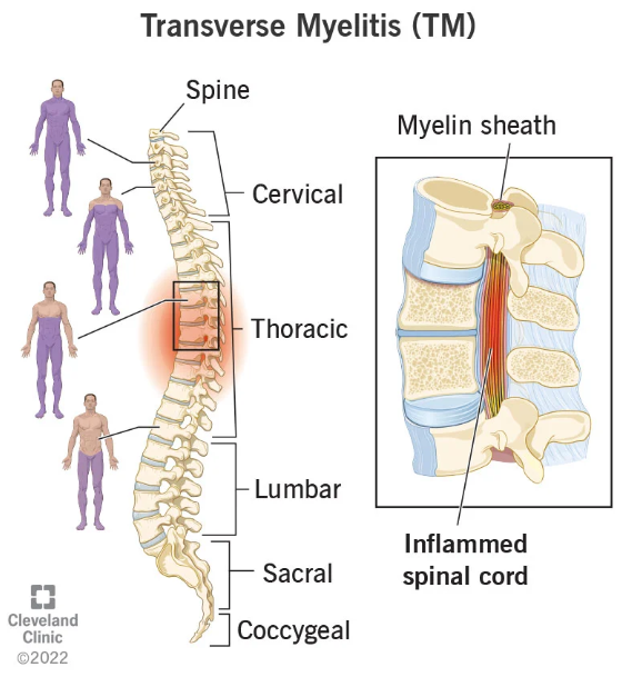 횡단성척수염TransverseMyelitis(TM)과 다발성경화증Multiple Sclerosis(MS) 임상증상/진단/치료 ...