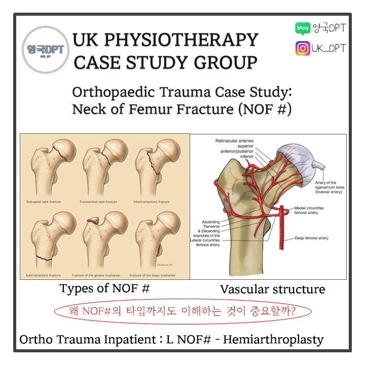 영국 물리치료 케이스 스터디 그룹 | Neck of Femur Fracture 대퇴경부 골절 | 영국에서 환자보기 | 정형외과 ...