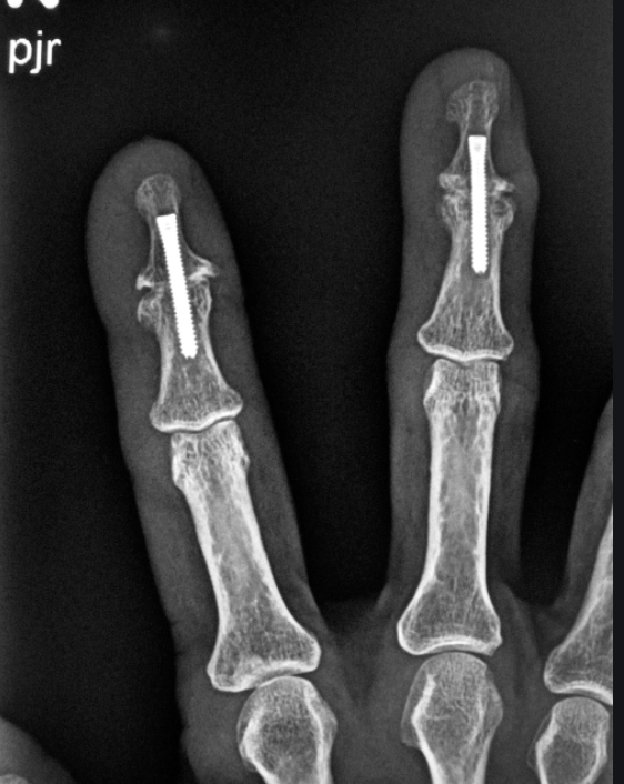 Hand-OA DIP fusion : 네이버 블로그