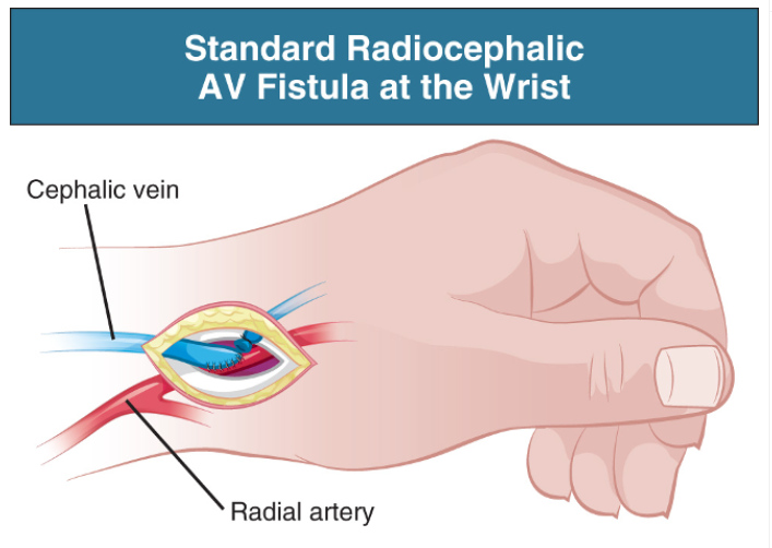 동정맥루(AVF) 종류 Radiocephalic AVF(RC AVF) Brachiocephalic AVF(BC AVF ...