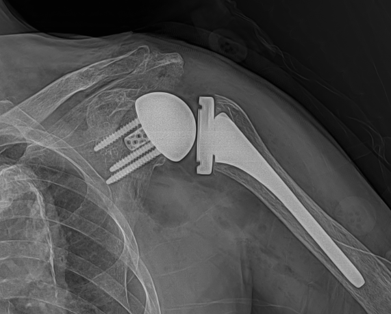 Shoulder- RTSA (Exactech Equinoxe) #역행성 견관절 인공관절 치환술 : 네이버 블로그