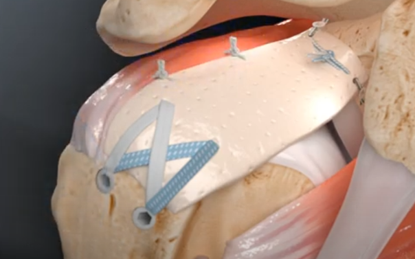 Shoulder-A/S SCR (superior capsular reconstruction) 어깨 상부 관절막 재건술 : 네이버 블로그