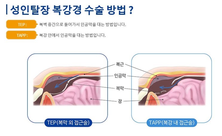 Lap-TEP : 네이버 블로그