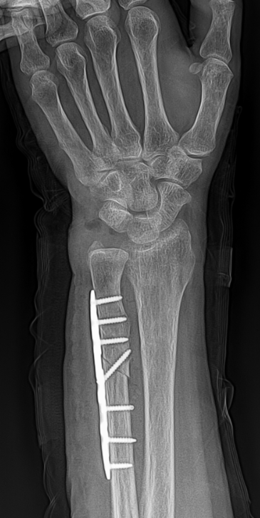 Wrist-Ulnar shortening osteotomy (USO) 척골단축술 + A/S TFCC debridement ...