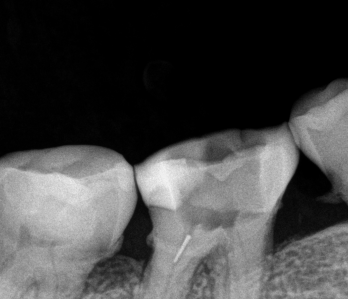 file fracture retrieval, 신경치료 중 부러진 파일 회수 방법과 개인적인 생각 : 네이버 블로그