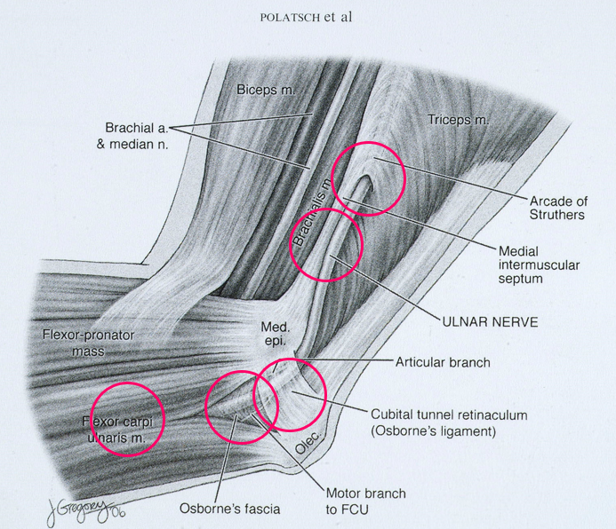 Elbow-Ulnar nerve decompression- prn) subcutaneous anterior ...