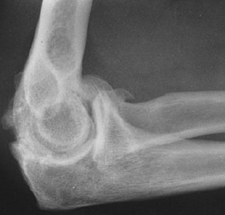 Elbow-OA stiffness - A/S osteophyte excision c capsular release / prn ...