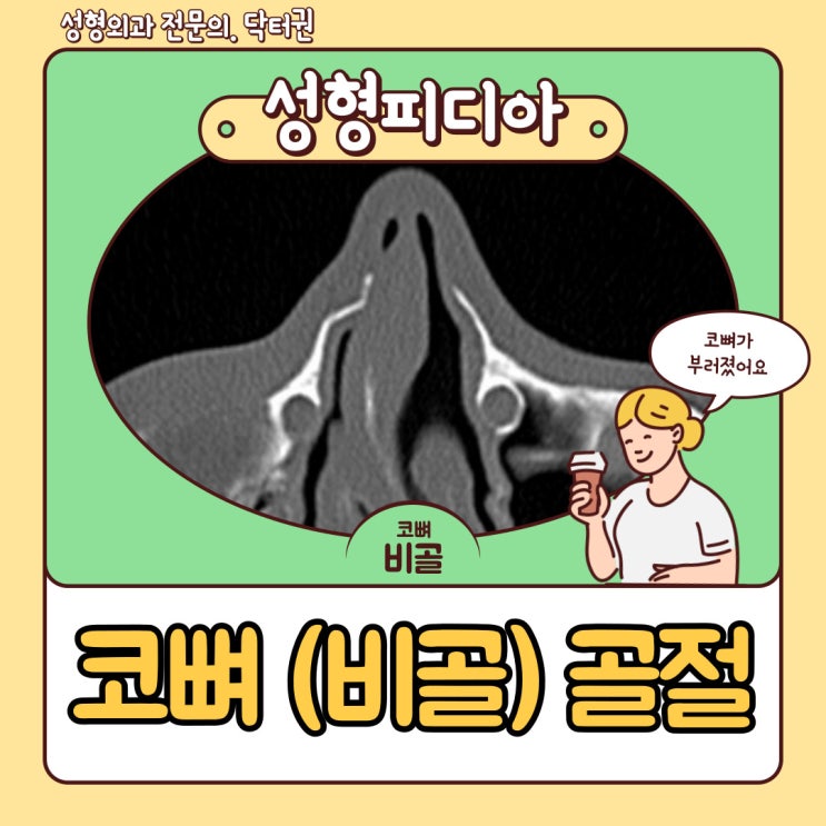 코뼈 골절 코뼈가 부러졌어요 Feat 비골골절 수술 비관헐적 정복술 네이버 블로그