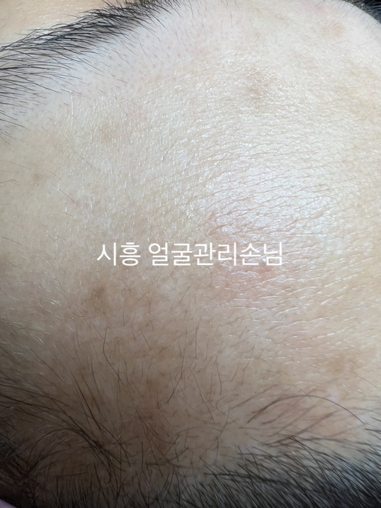 시흥피부관리손님 4주만의변화 부천상동피부관리실스킨엔 네이버 블로그