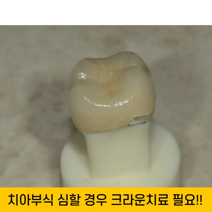치아부식 치료법과 예방법 : 네이버 블로그