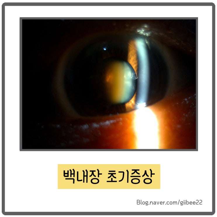 백내장초기증상 부터 백내장수술가격 까지 네이버 블로그