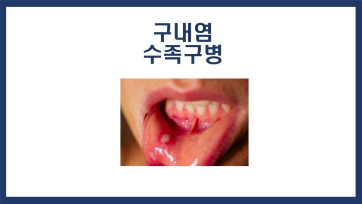 구내염 빨리 낫는 법 아프타성 구내염 원인약 연고 목구멍 입천장혀 수족구병 전염 등교 등원 소독 네이버 블로그