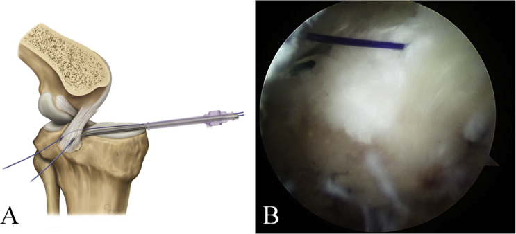 Knee-Fx-PCL avulsion / A/S reduction c pull out suture : 네이버 블로그