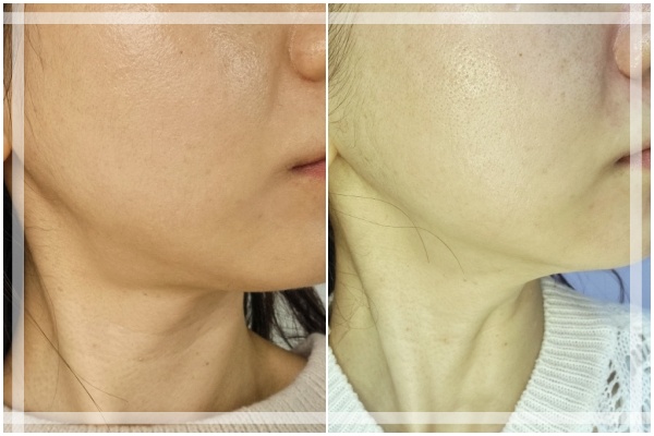 침샘보톡스 한달 후기 침샘비대증 치료 원인 증상 네이버 블로그