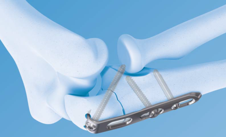 Fx-Elbow/ Olecranon Fx. OR/IF using hook plate 팔꿈치 주두 골절, 갈고리 금속판 고정 ...
