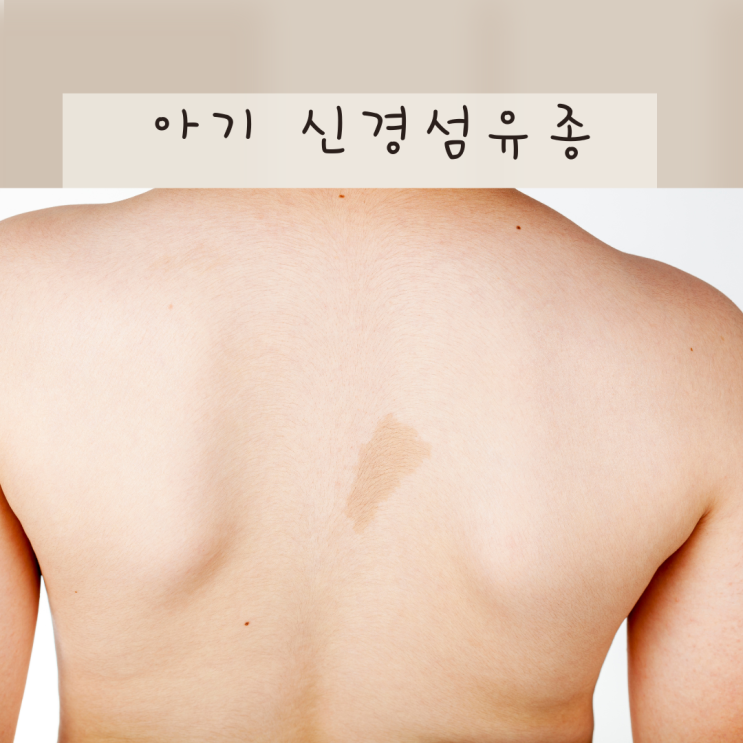 아기 신경섬유종 밀크 커피 카페오레 반점 얼굴 몸에 생긴다면 차이 알아야 해 네이버 블로그