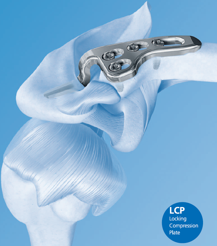 Fx-Shoulder /Distal clavicle Fx. / Hook plate 원위 쇄골 골절 / 갈고리형 금속판 고정 ...
