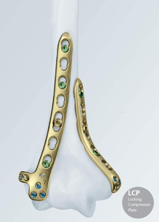 Fx-Elbow/ Distal humerus Fx. OR/IF using plate : 네이버 블로그