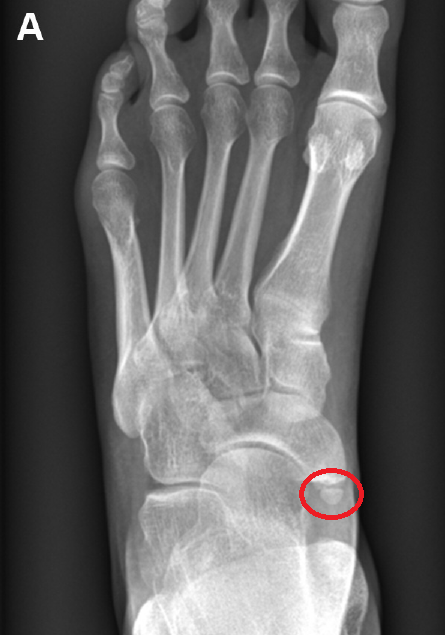 Foot-Accessory navicular (prehallux syndrome)- excision and PT ...