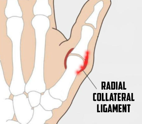 Hand-Thumb RCL repair using suture anchor c APB augmentation 엄지 중수지 관절 ...