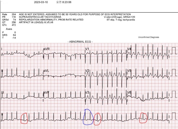 신기한 EKG/ AVRT with MAT, irregular psvt..? : 네이버 블로그