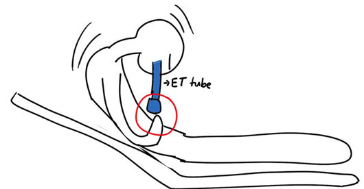 Self Extubation 예방법 및 대처법 : 네이버 블로그