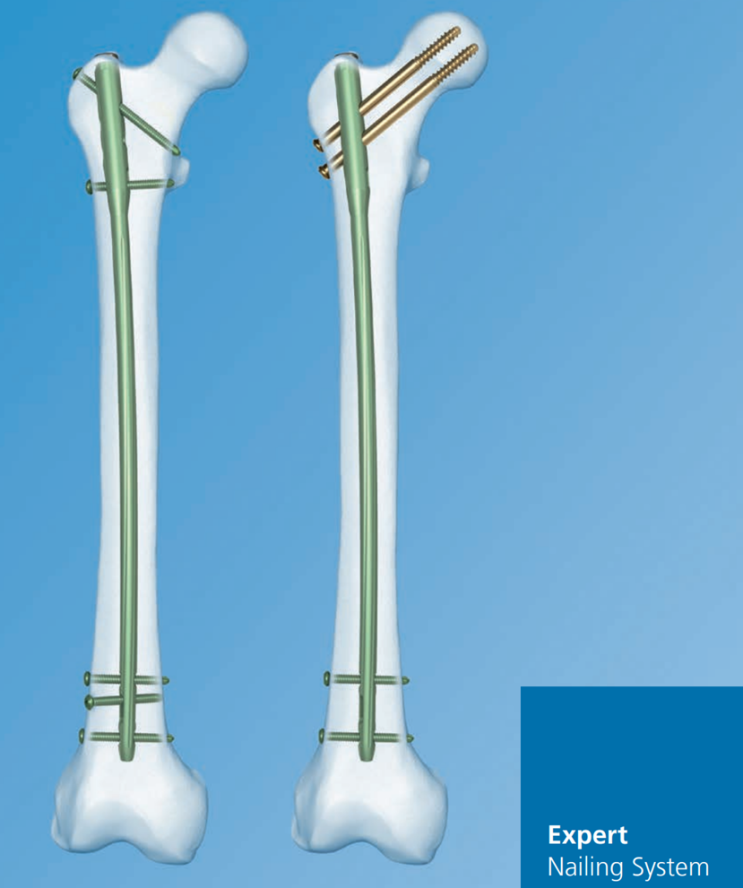 Fx-femur shaft Fx- CR/IM nailing using A2FN or TAN : 네이버 블로그