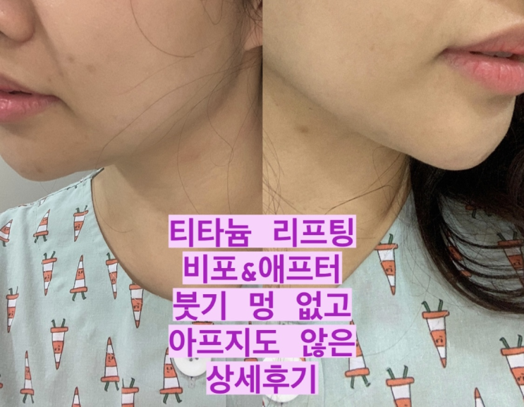 압구정로데오 티타늄리프팅 전후사진비교 유지기간 통증 붓기없음 상세 후기 네이버 블로그