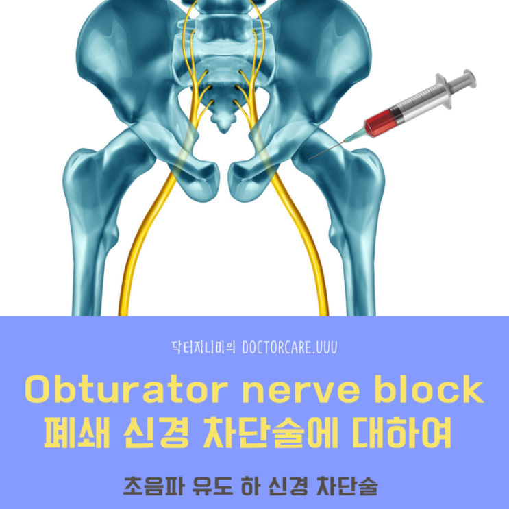 obturator nerve block 폐쇄신경 차단술, 초음파 유도하 신경차단술 방법과 팁 : 네이버 블로그