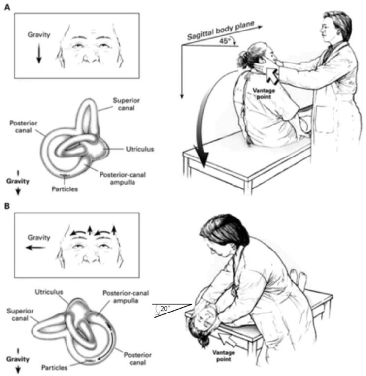 BPPV : 네이버 블로그