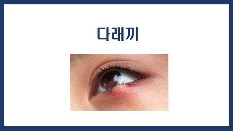 눈 다래끼 속다래끼 겉다래끼 콩다래끼 빨리 낫는 법 나는 이유 종류 전염 초기증상 치료 약 째기 수술 안대 렌즈 네이버 블로그