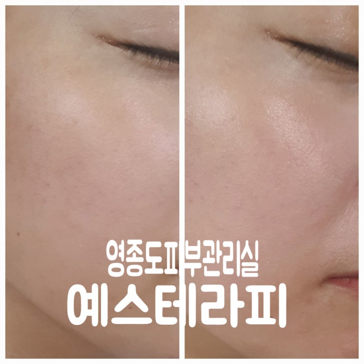 영종도피부관리실 재생 탄력관리 예스테라피 솔직후기 네이버 블로그