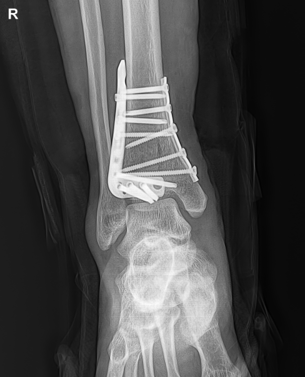 Fx-Pilon Fx (Distal tibia articular Fx) OR/IF
